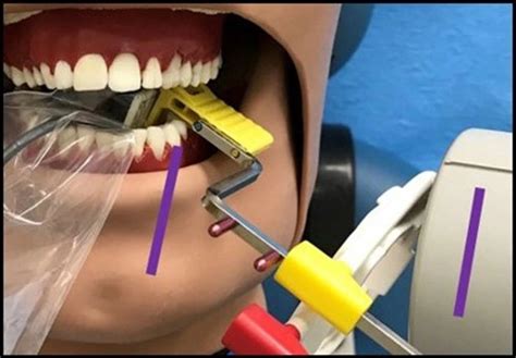 Vertical Angulation How Do I Know If I Can Follow The Aiming Ring Intraoral Imaging