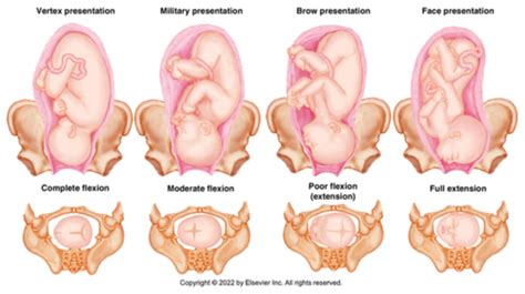 Ob Week 6 Intrapartum Flashcards Quizlet