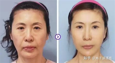 筋膜悬吊提升术能保持多久专业人士讲悬吊术可以维持多久 知乎