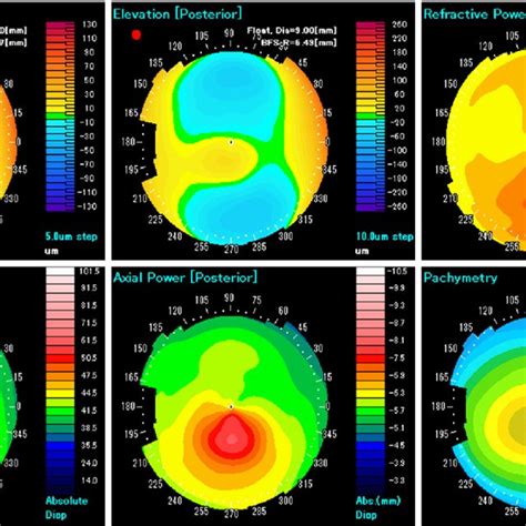 Representative Example Of 6 Color Coded Maps Anterior Elevation