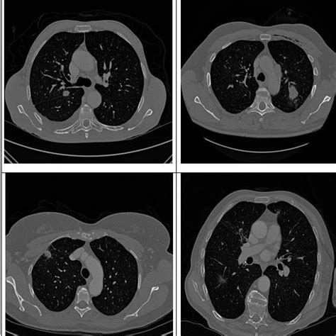 Pdf Lung Cancer Classification With Convolutional Neural Network Architectures
