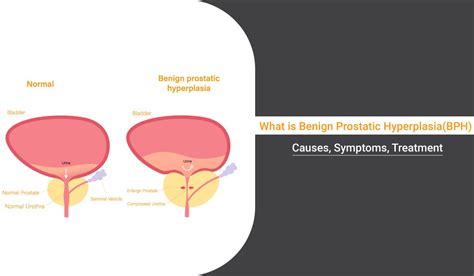 Benign Prostatic Hyperplasia Clinical Focus And Treatment
