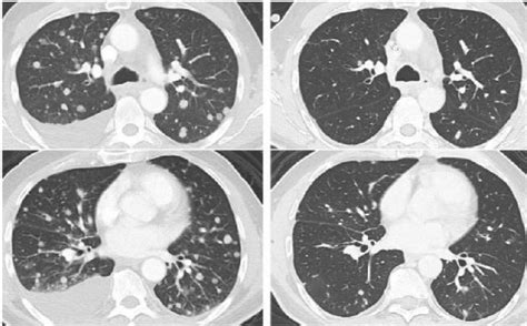 Neoantigen Specific Tumor Infiltrating Lymphocytes In Gastrointestinal Cancers Oncodaily