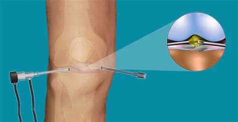 Knee Arthroscopic Surgery Orygyn Clinic