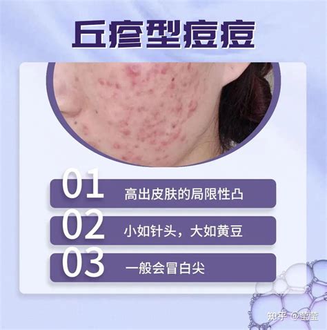 怎么祛痘才好 知乎