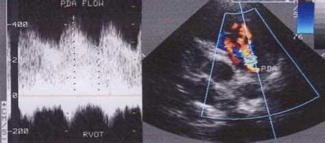 Patent Ductus Arteriosus PDA