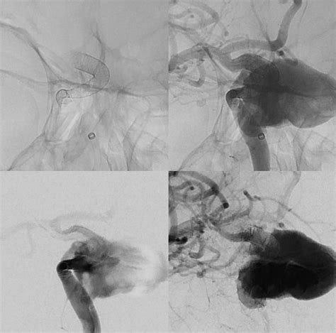 Large Paraophthalmic Aneurysm Pipeline Insufficient Coverage