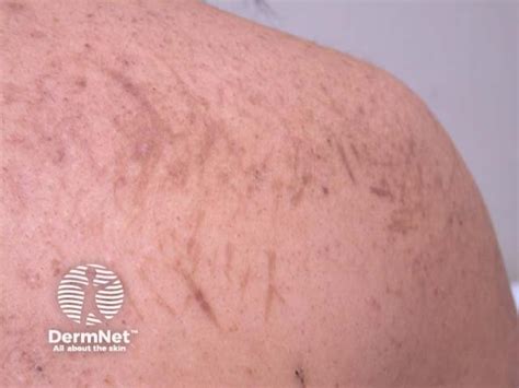 Pigmentation Disorders