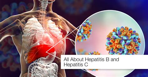 Hepatitis B And Hepatitis C Hepatitis B And Hepatitis C Prevention