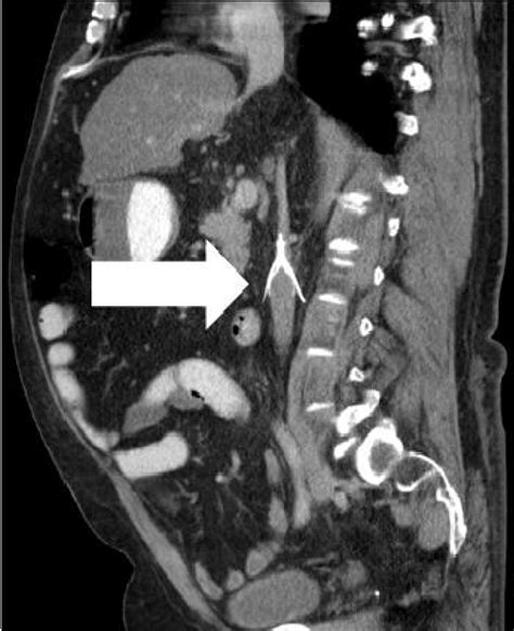 Coronal View Of A Inferior Vena Cava Ivc Filter With Strut Visible Download Scientific