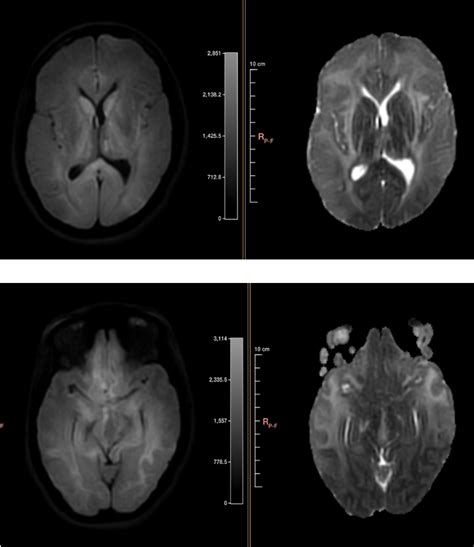 Neuroradiology Nuggets Fulminant Cerebral Edema In Sle Associated