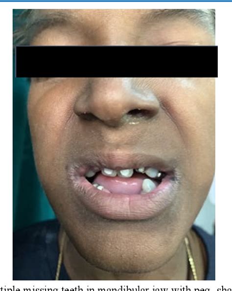 Figure 1 From Ectodermal Dysplasia ‑ A Case Report From Nepal Semantic Scholar