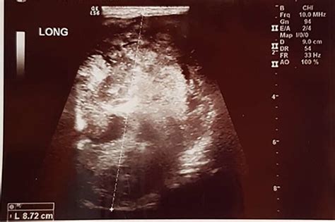 Ultrasound Of Scrotum Download Scientific Diagram