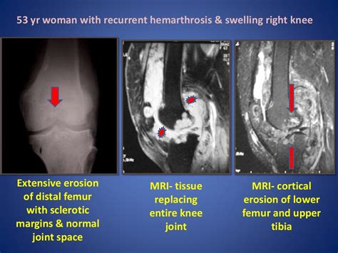 Pigmented Villonodular Synovitis31may16