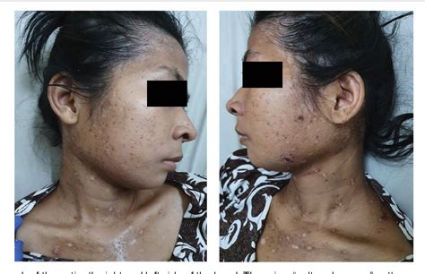 Figure 2 From Diffuse Cutaneous Systemic Scleroderma With Secondary