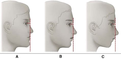 Class Ii Detailed The Ortho Guide