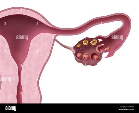 Multiple Follicles In Right Ovary Means Zucnys