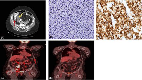 A CT Scan Showing A Dilated Appendix With Periappendiceal Stranding Download Scientific