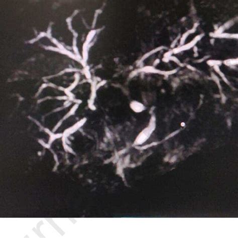 Magnetic Resonance Cholangiopancreatography Image Showing The Typical