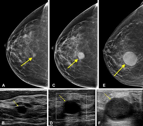 Understanding Bi Rads Category 3radiographics