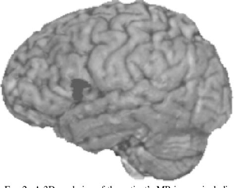 Figure 1 From Resection Of A Left Insular Cavernoma Aided By A Simple