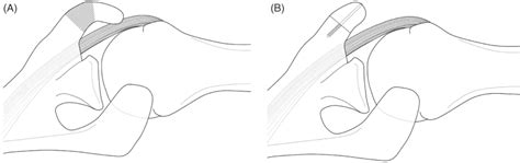 Coracoid Impingement Treated With Corrective Osteotomy A Case Report