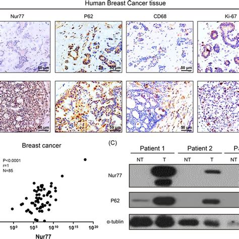 Expression Of Nur77 And P62 In Human Breast Cancer Tissue Samples A Download Scientific