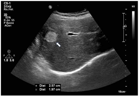 Figure 1 From The Case Of A Liver Adenoma That Looked Like A Hemangioma