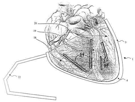 Device For The Epicardial Support Andor Resumption Of Cardiac Activity