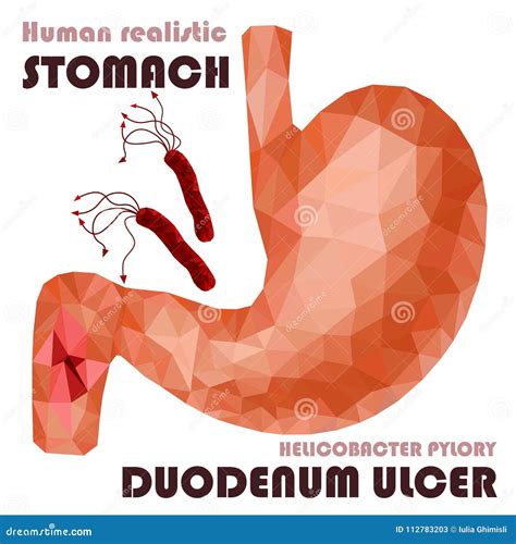Realistic Low Poly Human Stomach And Inflammation Of The Duodenum Healthy Stomach Ulcer