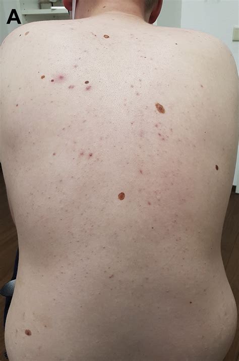 Dysplastic Nevi Surgical Pathology Clinics