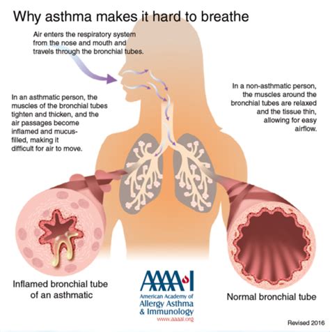 Asthma Flashcards Quizlet