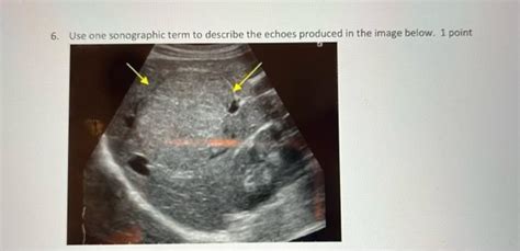 Solved Sonography Terms Anechoic Complex Echogenic