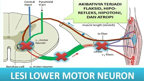 What Is A Lmn In Medical Terms