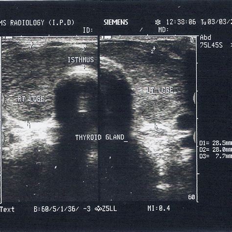 Usd Thyroid Showing Diffuse Enlargement Of The Thyroid Download