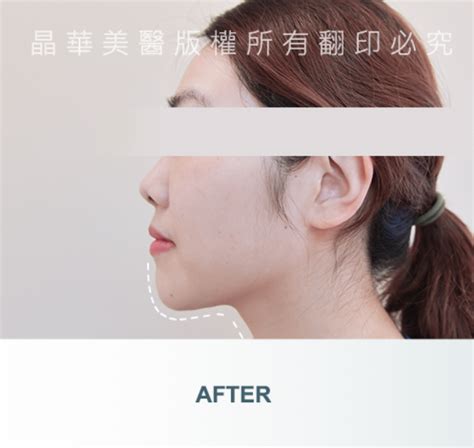 藍鑽魚骨線 台北 桃園埋線拉線 複合式提拉 晶華醫美