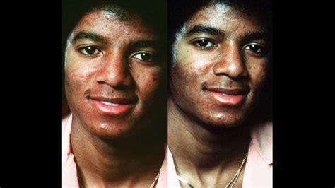Eine Haut Wie Michael Jackson Vitiligo Lbbj