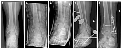 Broken Tib Fib External Fixator On