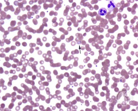 Plasmodium Vivax 1