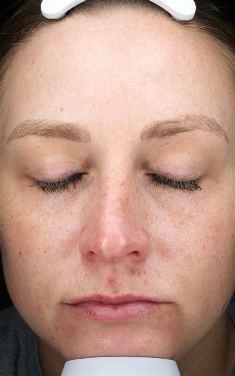 Bbl Moxi 9 Aestheticare Aestheticare