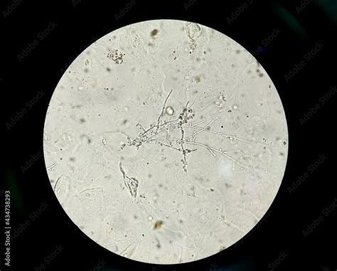 Fungal Yeast Budding Yeast And Pseudohyphae Of Candida Albicans