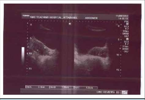 Hyperechoic Small Ovarian Dermoid Cyst Download Scientific Diagram