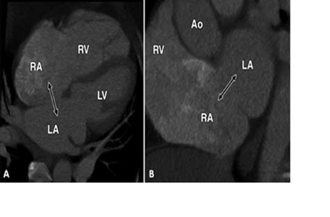 CONGENITAL HEART DISEASE CVT Flashcards Quizlet