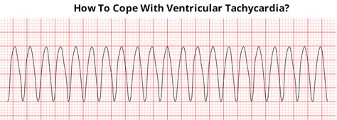 Ventricular Tachycardia Causes Symptoms Treatment