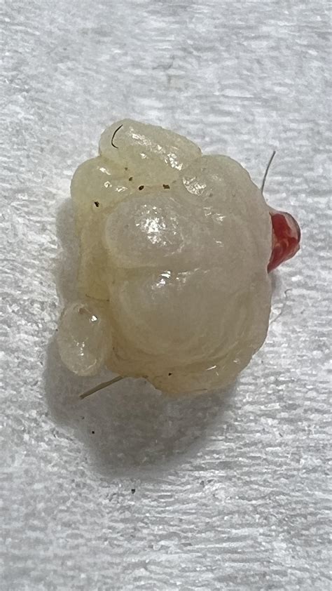This Just Fell Off My Butt And Started Bleeding R Diagnoseme