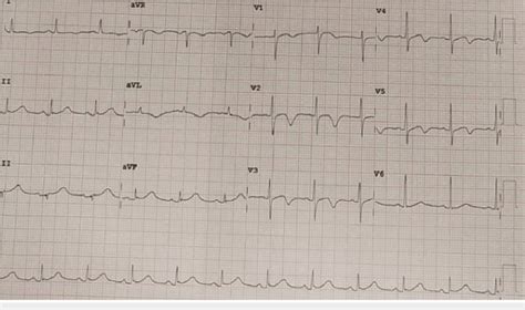 ECG Showing ST Segment Depression With T Wave Inversion In Chest Leads Download Scientific Diagram