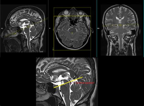 Cerebrospinal Fluid Flow MRI CSF Flow MRI Protocol And Planning