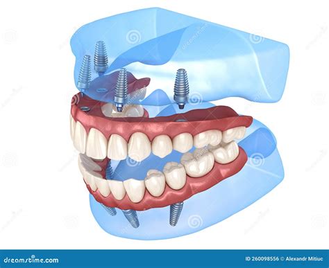 Maxillary And Mandibular Prosthesis With Gum All On 4 System Supported By Implants Medically