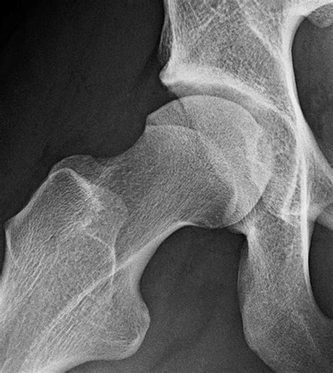 Femoroacetabular Impingement Arlington Va Nirschl Orthopaedic Center