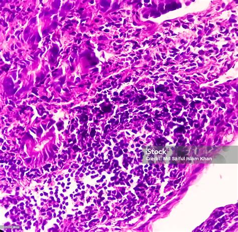 Tissue From Terminal Ileum Chronic Nonspecific Ileitis Or Inflammation Of The Ileum Is Often